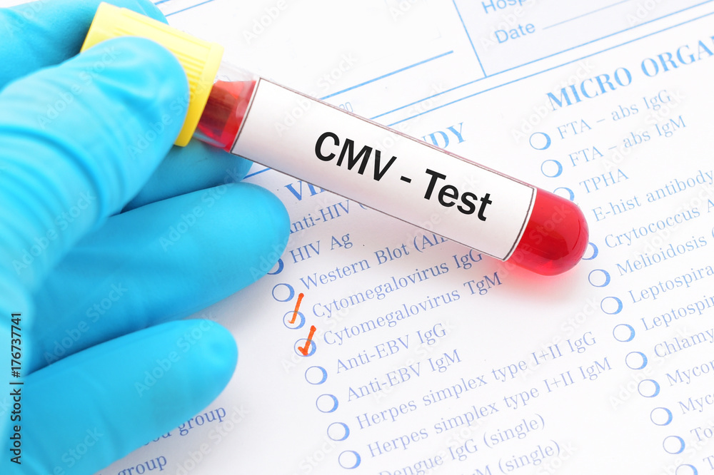 Foto de Blood sample with requisition form for cytomegalovirus (CMV ...