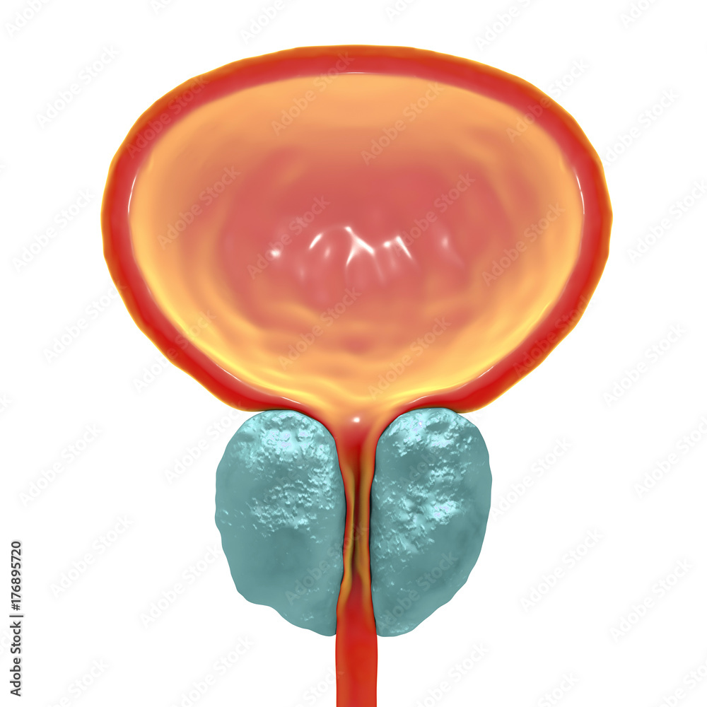 Benign prostatic hyperplasia, 3D illustration showing enlarged prostate ...