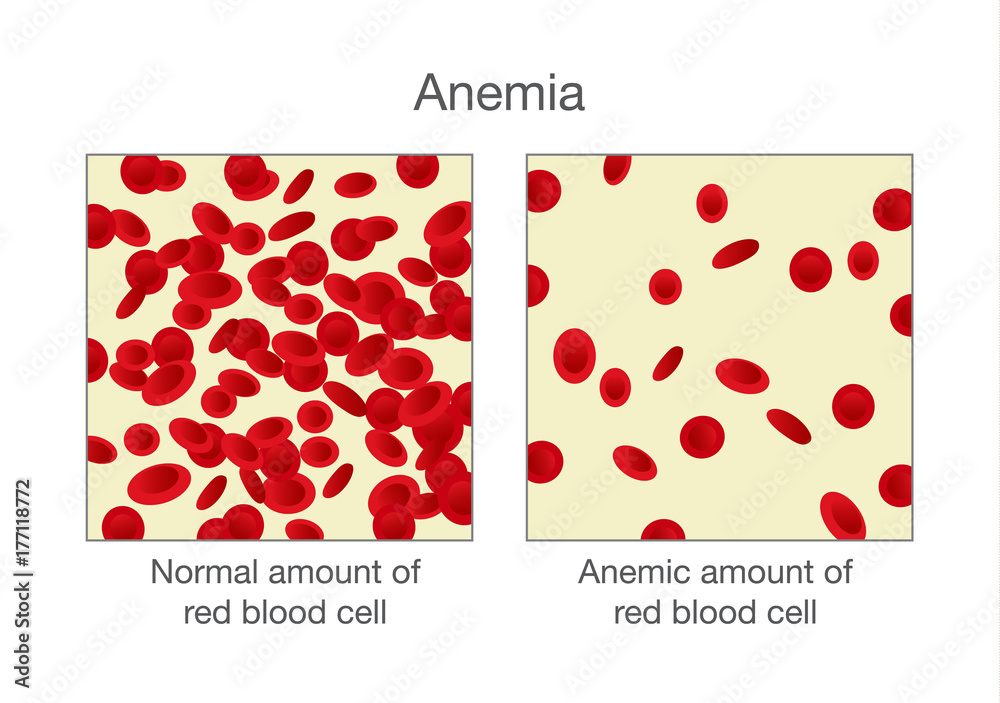 The difference of normal amount of red blood cell and Anemia ...