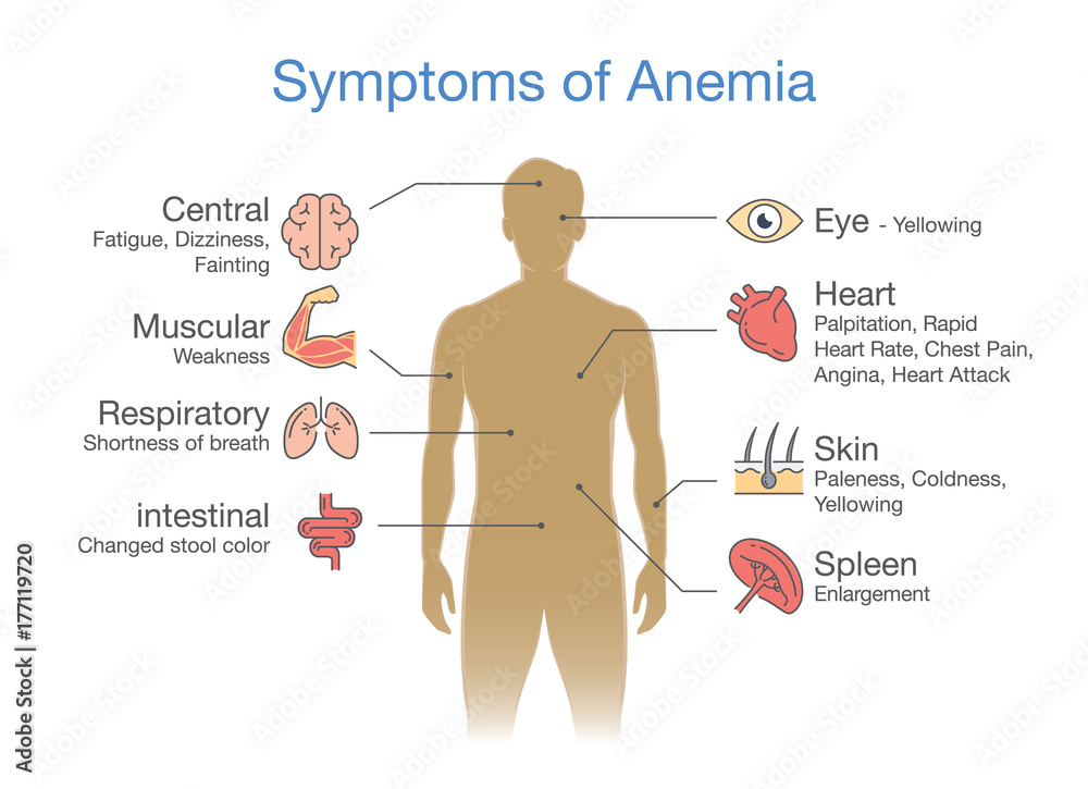 The most common Symptom of Anemia. Illustration about medical diagram ...
