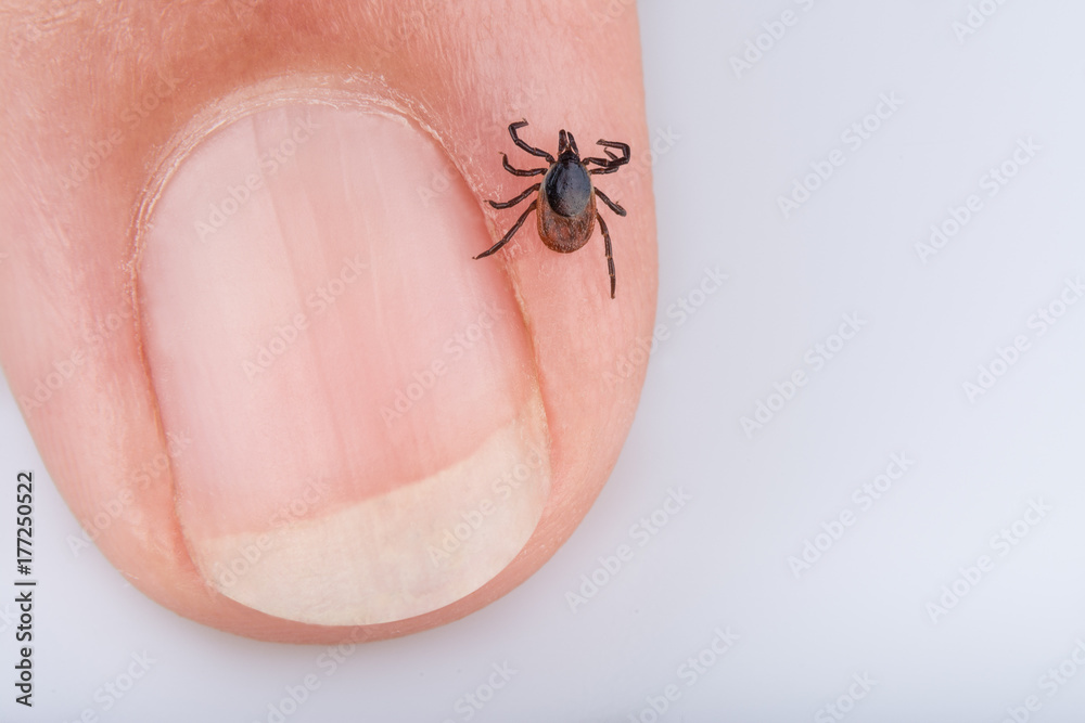 Detail of tick on human fingertip. Ixodes ricinus. Dangerous parasite ...