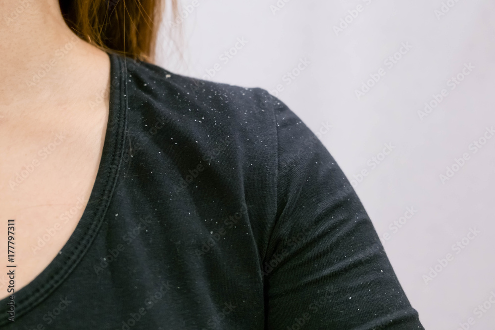 women having dandruff in the hair and shoulder. Women have itchy scalp ...