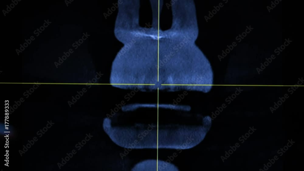 toothache symptom. X-ray of the human jaw on the computer. The doctor ...