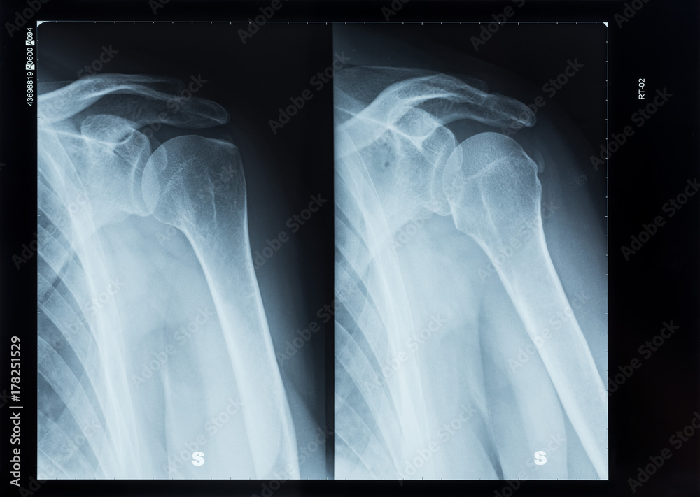 X-ray of woman left shoulder Stock Photo | Adobe Stock