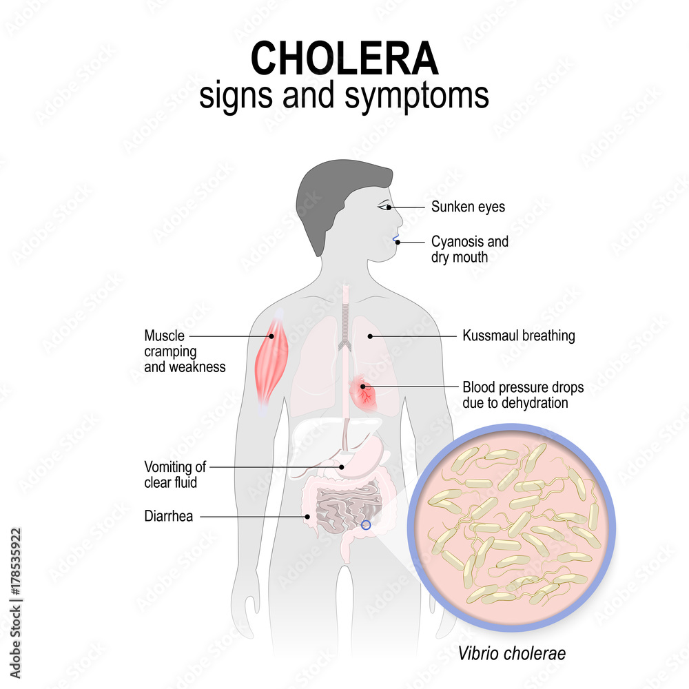 cholera. Signs and symptoms. Stock Vector | Adobe Stock