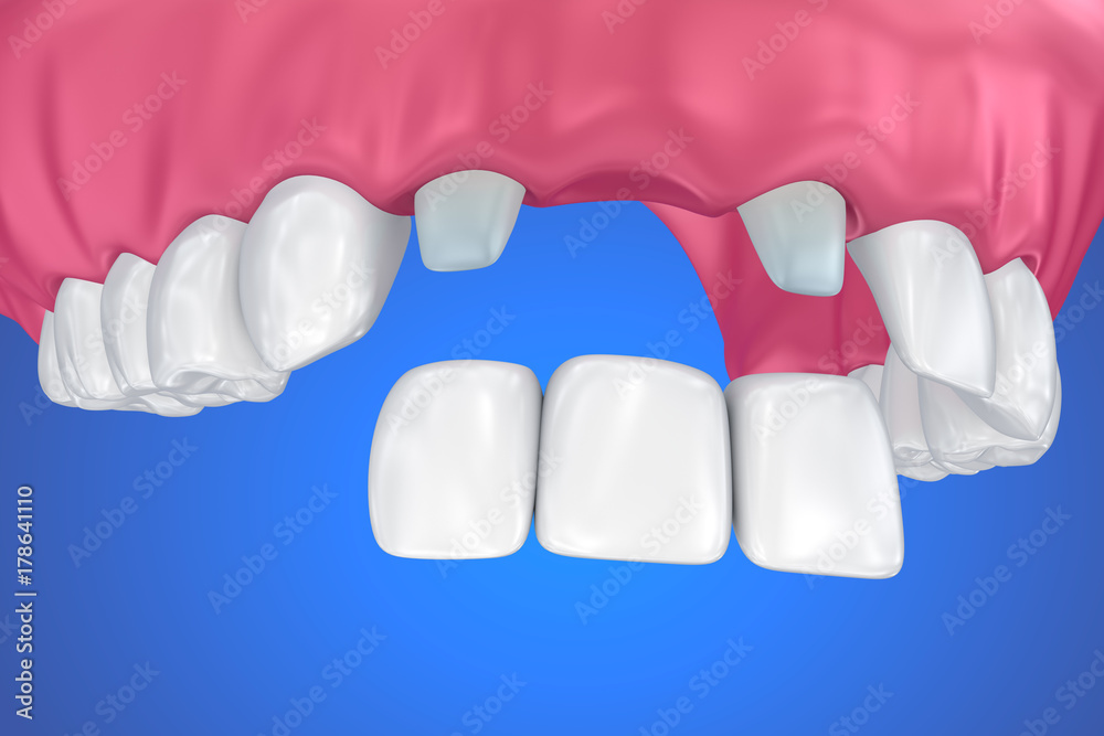 Tooth supported fixed bridge. Medically accurate 3D illustration foto ...