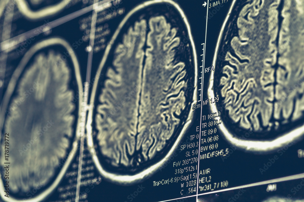 MRI brain scan or x-ray neurology human head skull tomography test ...