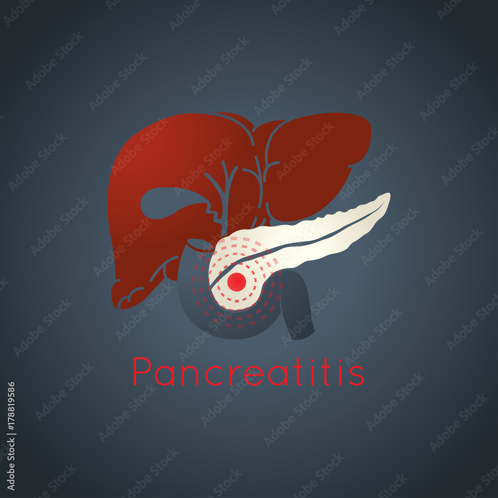 Pancreatitis vector logo icon illustration Stock Vector | Adobe Stock