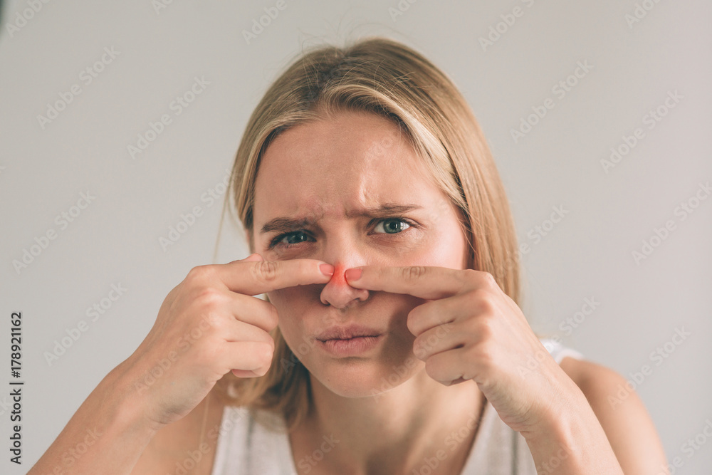 Acne treatment. Acne woman. Young woman squeezing her pimple, removing ...