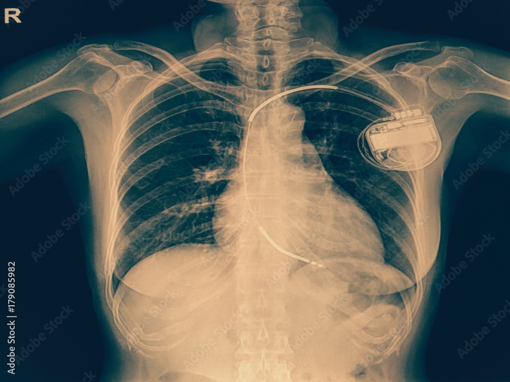 Chest x-ray image of permanent pacemaker implant in body chest. Stock ...