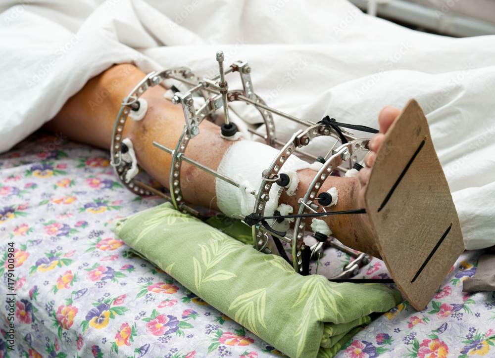 leg in Ilizarov's external fixator, Ilizarov's apparatus Stock Photo ...