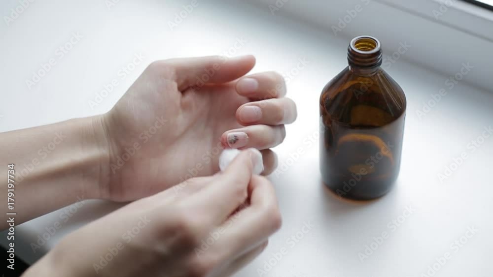 Horrible trauma of fingernail. Subungual hematoma. Bruise under the ...