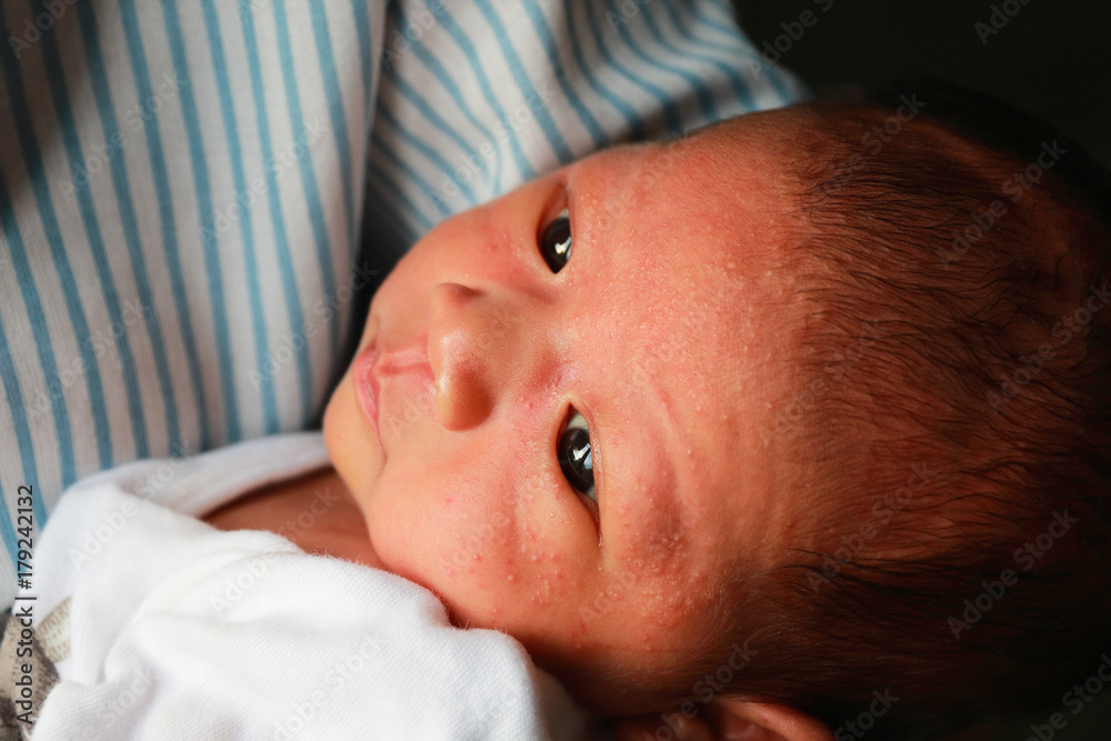 newborn baby is allergic to milk,there is rash on face Stock Photo ...