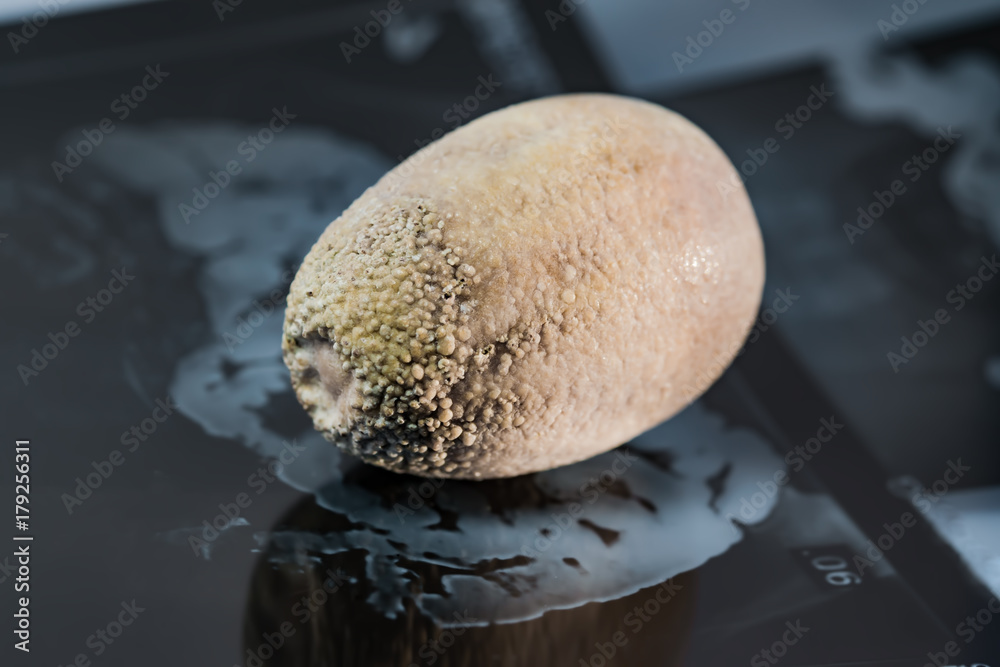 A large stone from the gallbladder on the background of the x-ray of ...