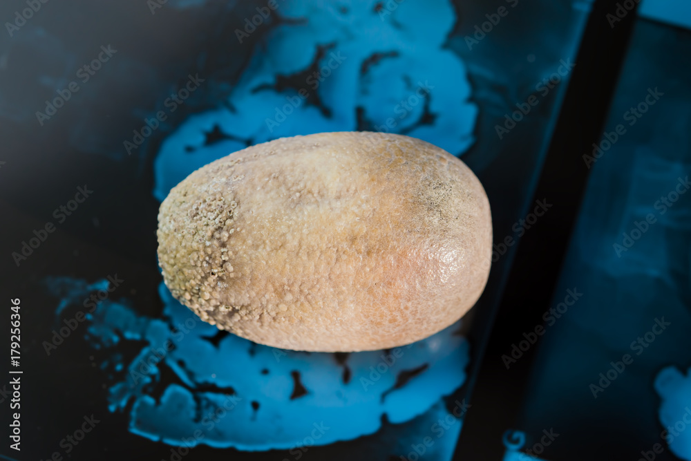 A large stone from the gallbladder on the background of the x-ray of ...