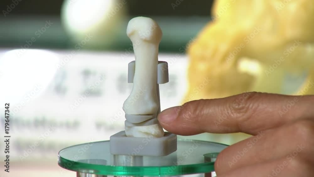 Prosthesis for the metacarpal bone printed in 3D. Quervain syndrome ...