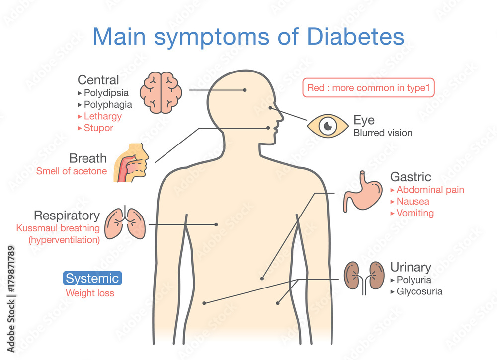 Vecteur Stock Main symptoms of Diabetes. Illustration about diagram for ...