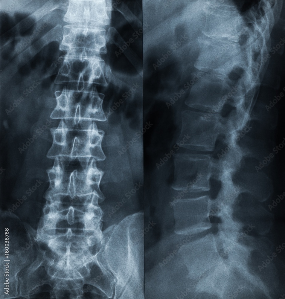 X-Ray of the Spine Stock Photo | Adobe Stock