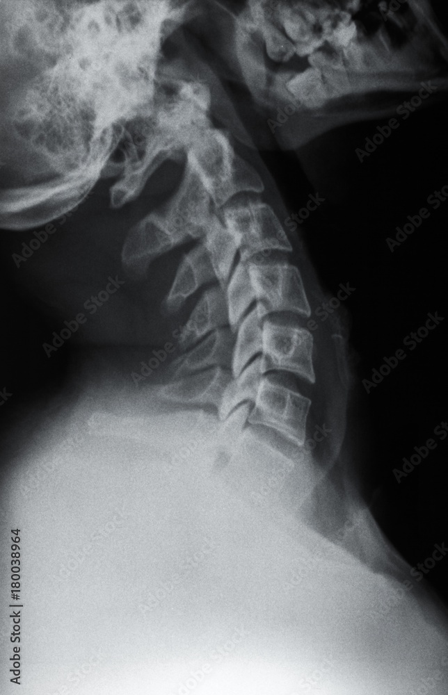 X-Ray of the Neck Stock Photo | Adobe Stock