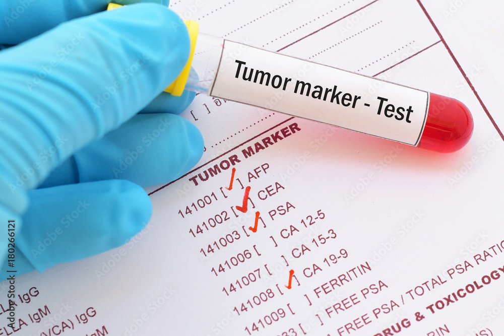 Blood sample with requisition form for tumor marker test in male Stock ...
