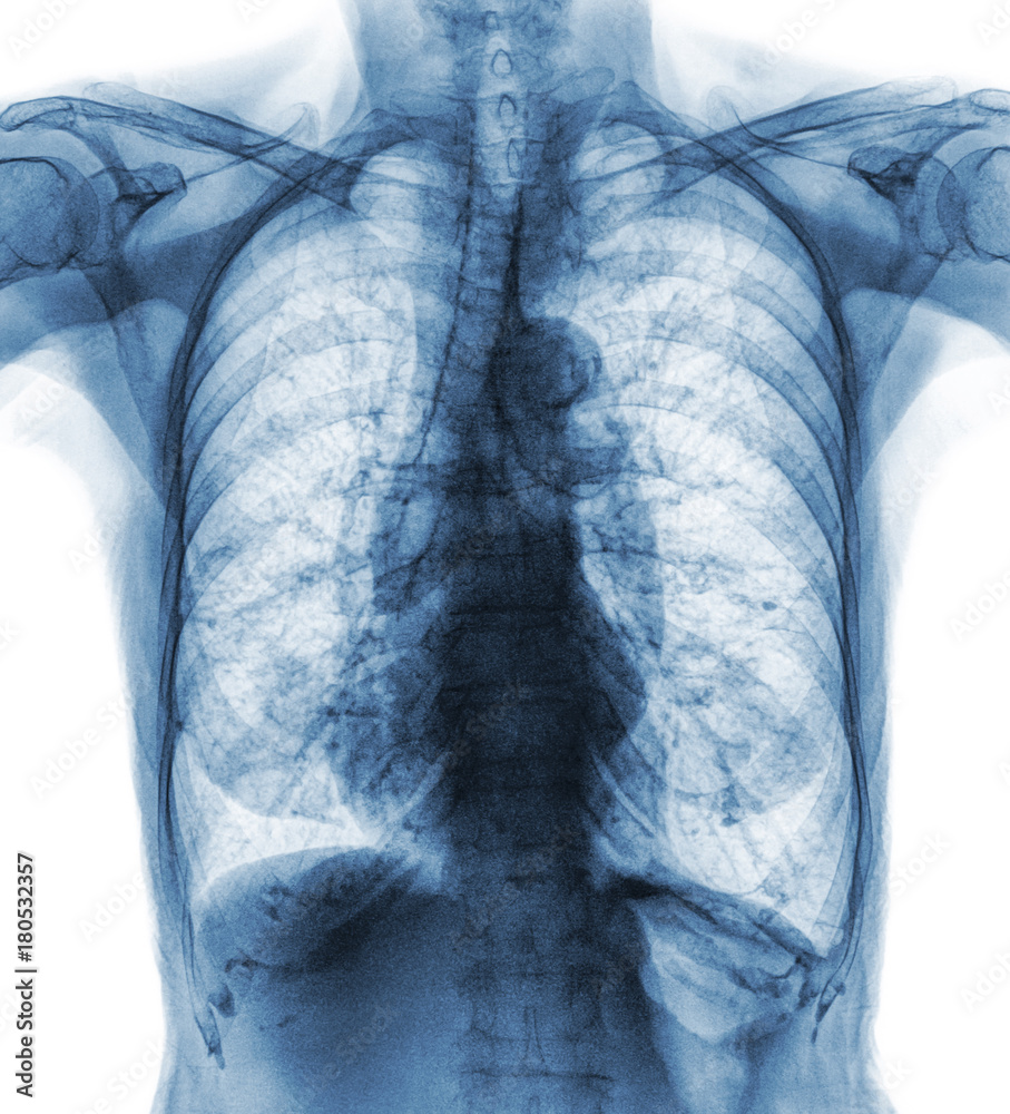 Normal chest X-ray of old patient . You can seen calcification at rib ...