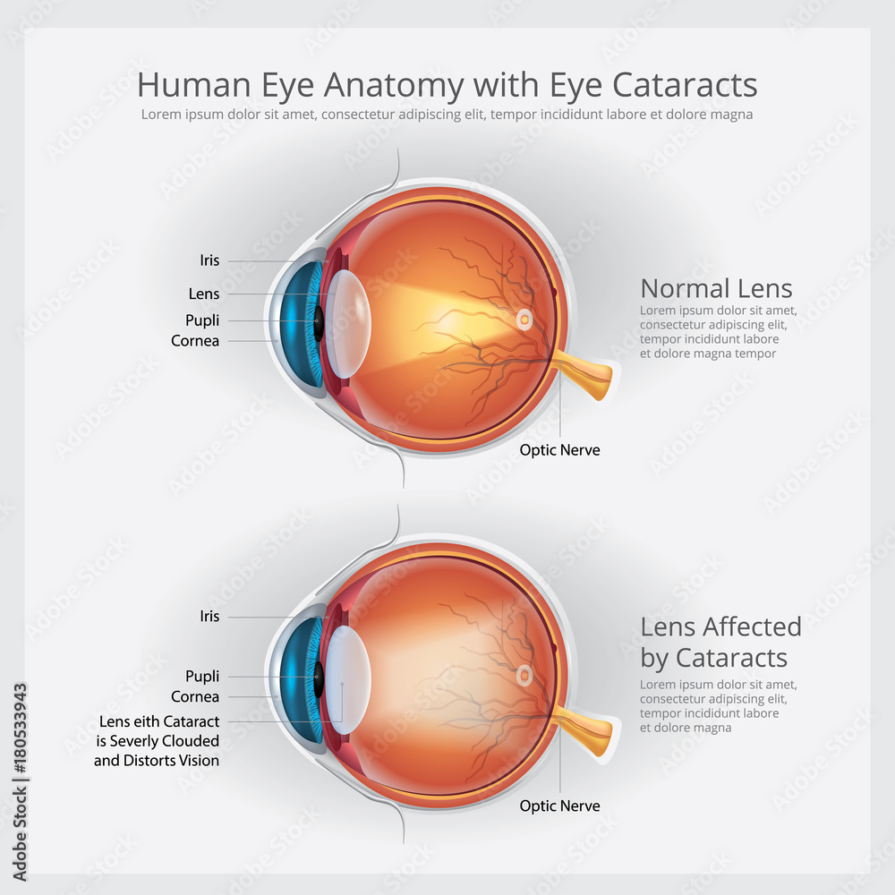 Cataracts Vision Disorder and Normal Eye Vision Anatomy Vector ...