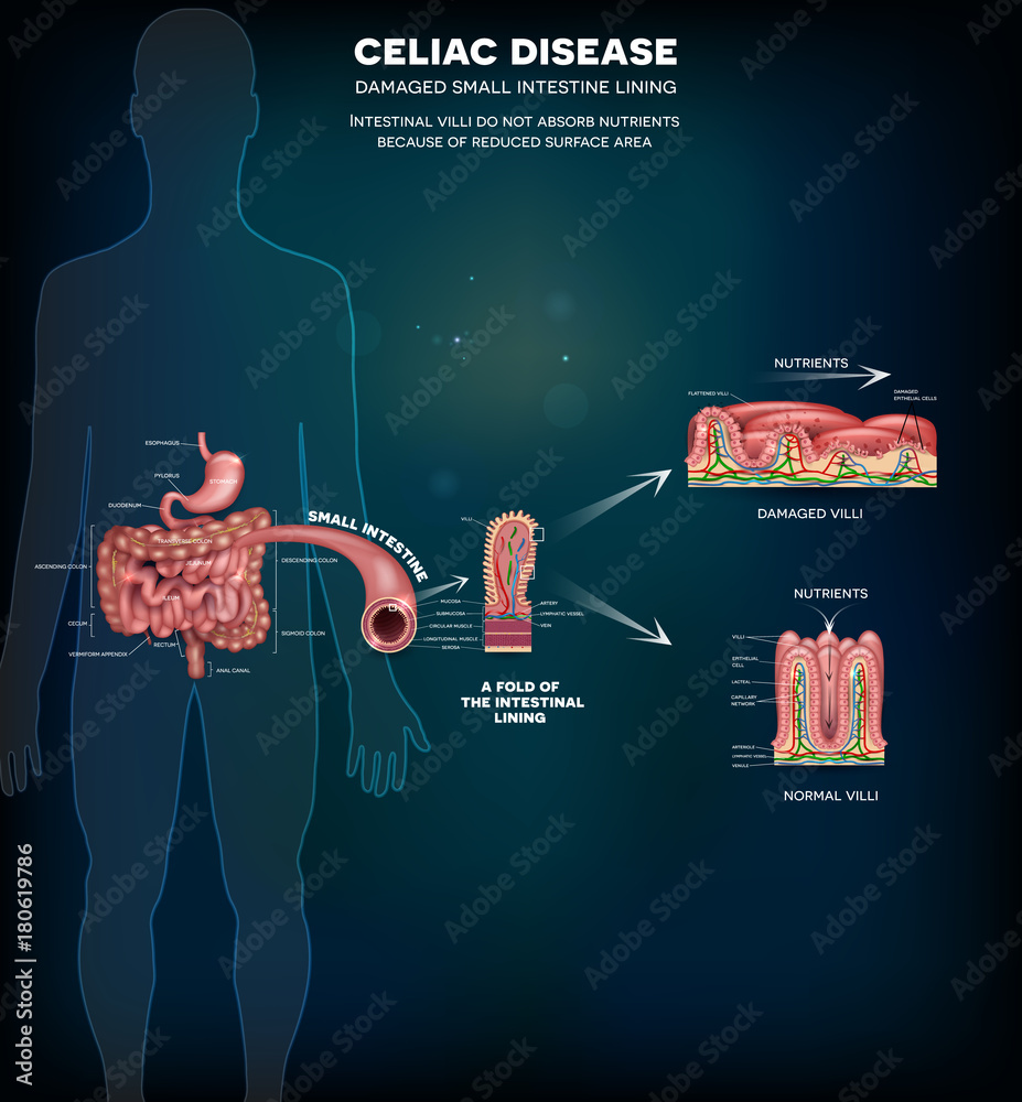 Small Intestine Villi Celiac Disease