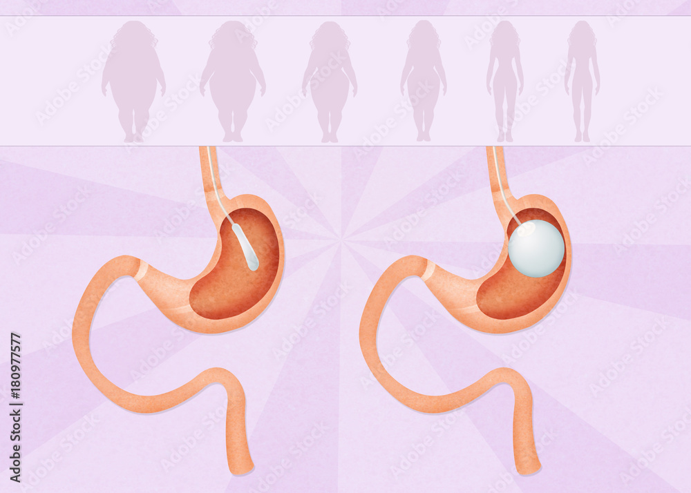 intragastric balloon Stock Illustration | Adobe Stock