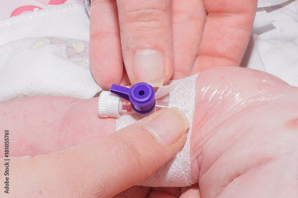 Intravenous catheterization of newborn baby in neonatal intensive care ...