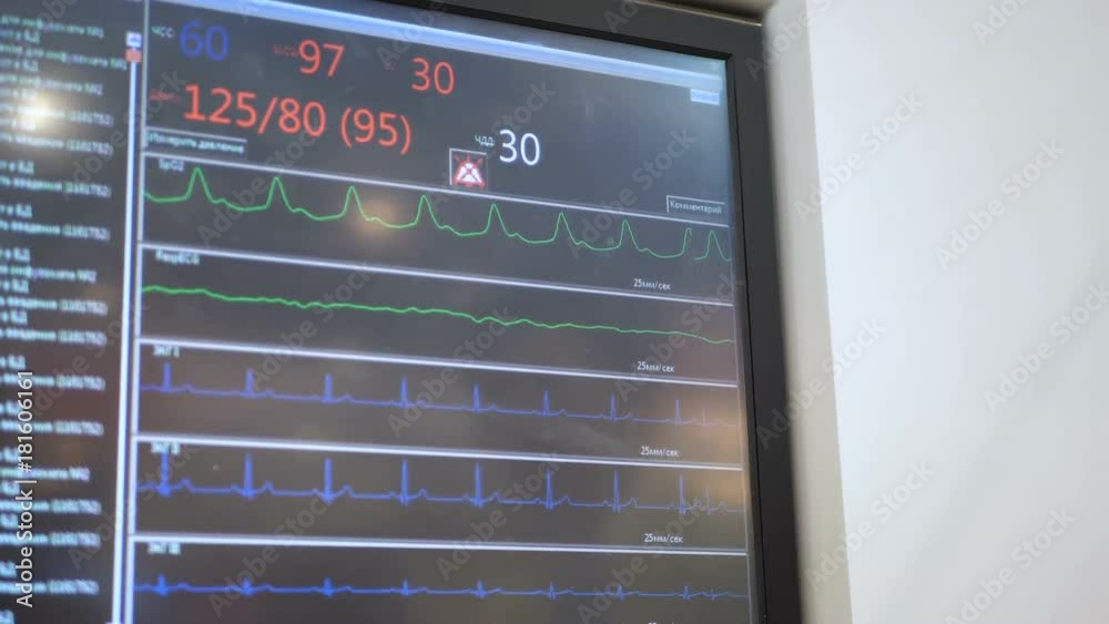 Ecg monitor patient's condition in operating room,close up heartbeat on ...