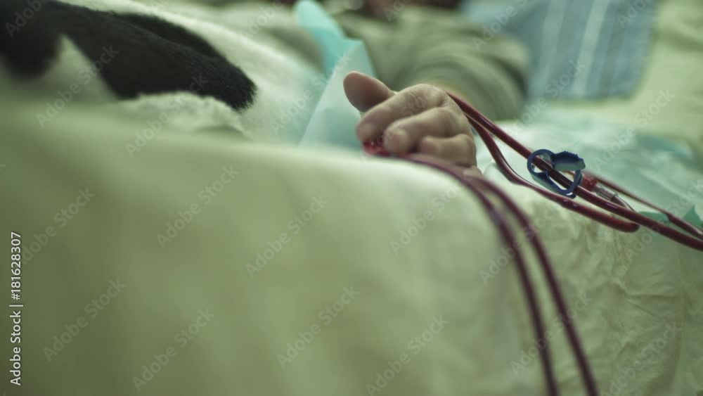 Tilt up from the pipes injected in hand of hemodialysis patient during ...