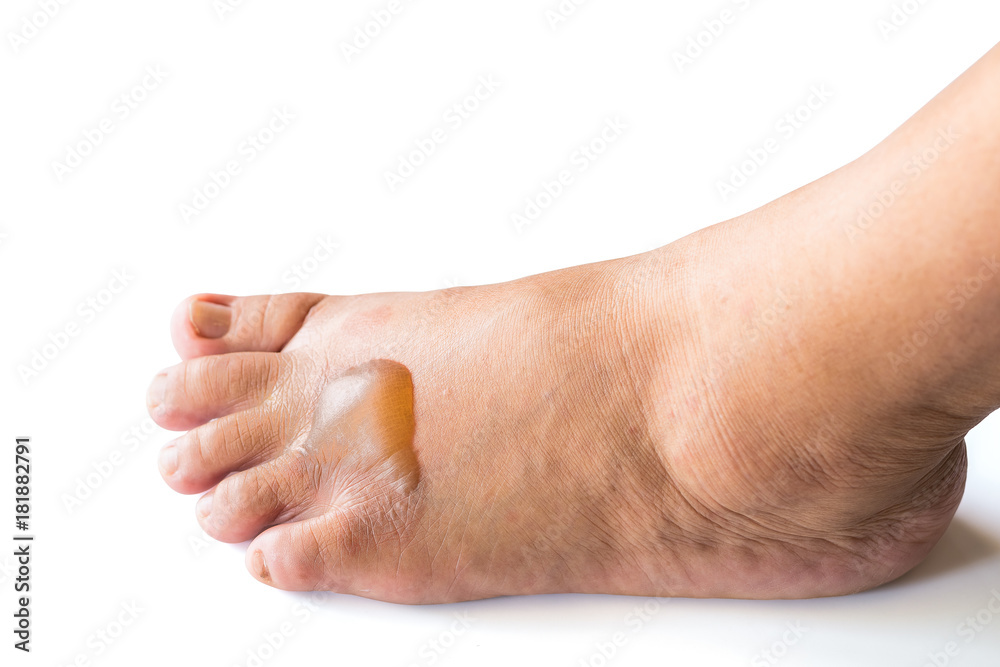 Poster The scald on the foot skin caused by the boiling cooking oil ...
