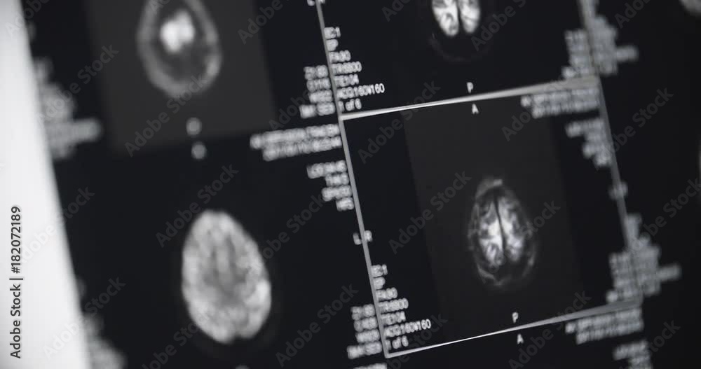 MRI Head Scans Angled Close Up Pan Right. view pans right on an angled ...
