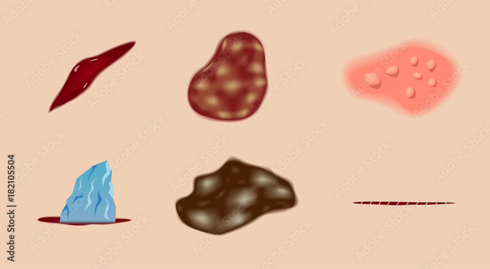 bleeding, wound on skin. A set of cuts blood and bruises , vector Stock ...