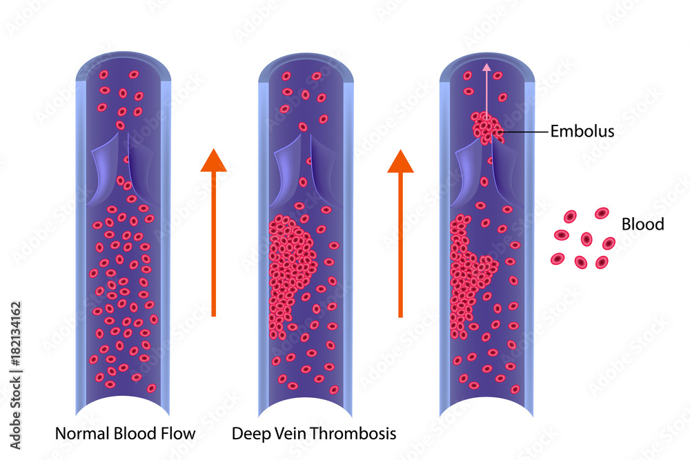 Thrombosis. Vector illustration Stock Vector | Adobe Stock