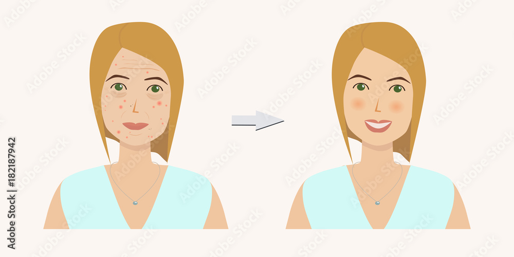 Woman's face with skin problems before and after skin treatment ...