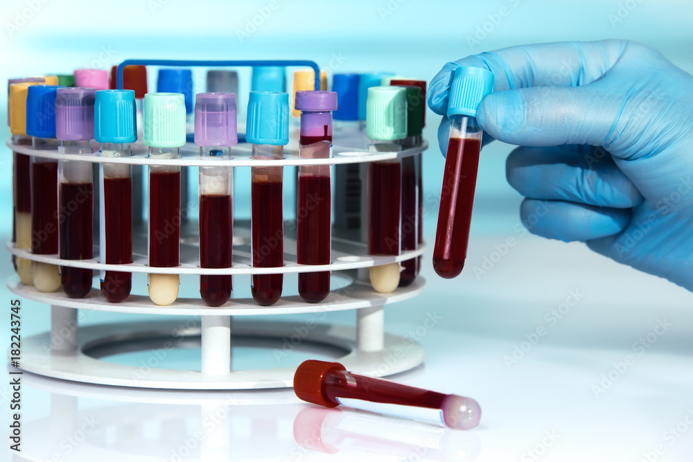 technician holding tube of blood samples in the laboratory / doctor ...
