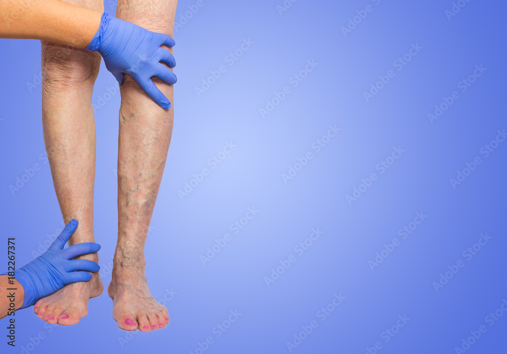 Lower limb vascular examination because suspect of venous insufficiency ...