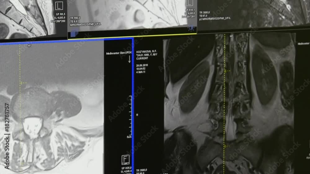 Spinal cord and spinal column tomography on MRI scan. Diagnosis of a ...