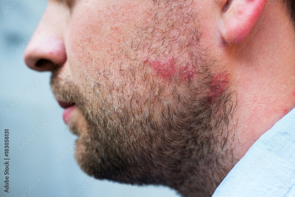 Rash reaction from drug or food allergy on face of caucasian man Stock ...