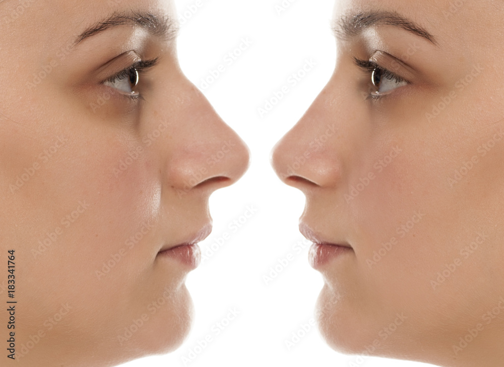 Nose plastic surgery before, and after Stock Photo | Adobe Stock