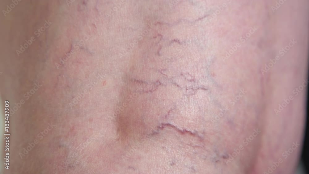 SLOW MOTION CLOSE UP: Unknown lady's curved red varicose veins running ...