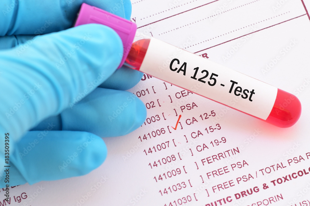 Blood sample with requisition form for CA 125 test, tumor marker for ... Blood sample with requisition form for CA 125 test, tumor marker for ...