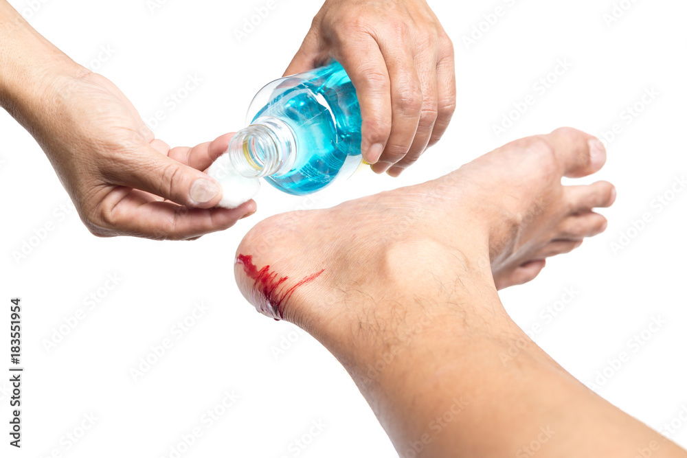 Nurse cleaning wound on patient with Isopropyl alcohol isolated in ...
