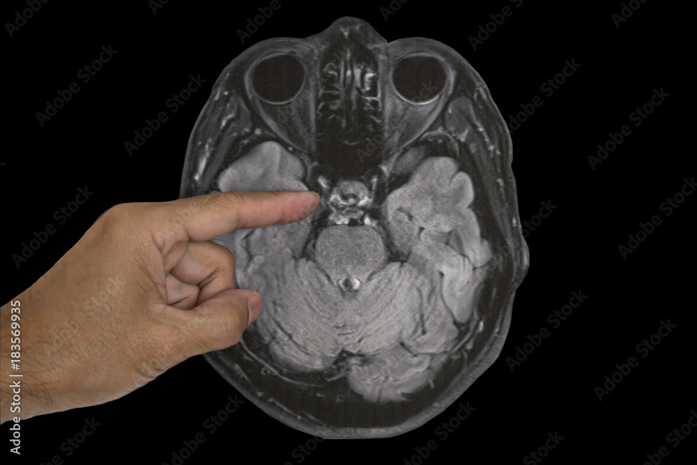 Axial View Of Brain