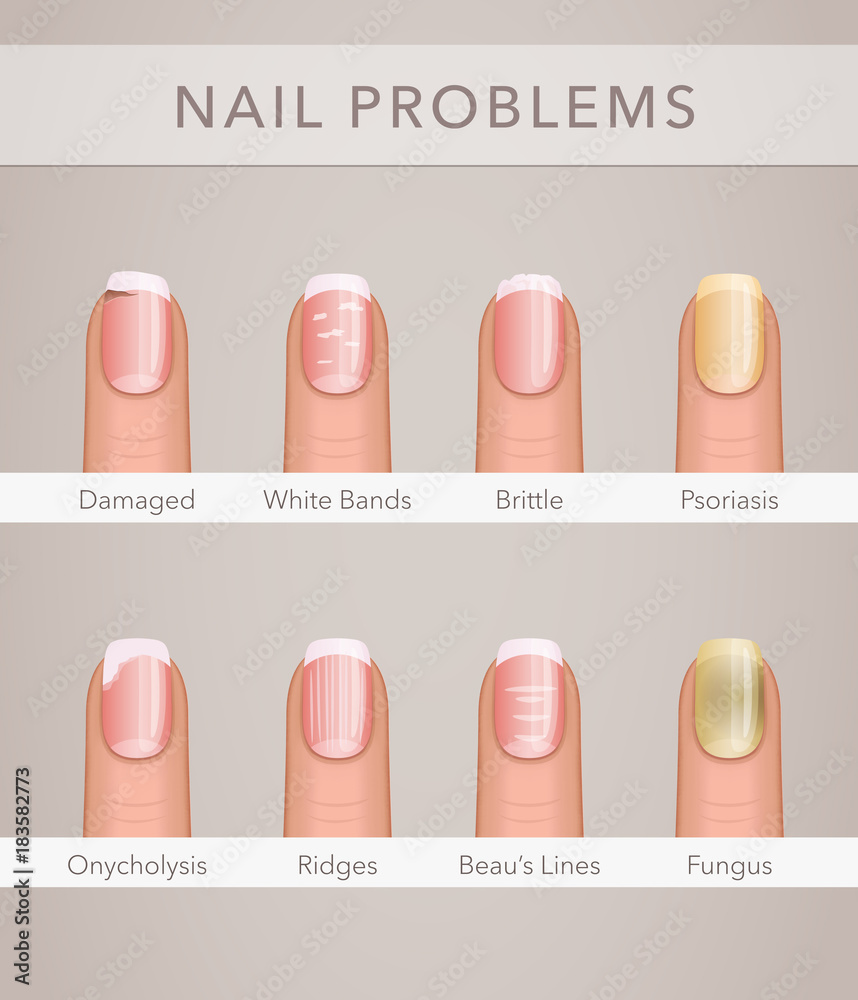 nail problems and illness, vector poster Stock Vector | Adobe Stock