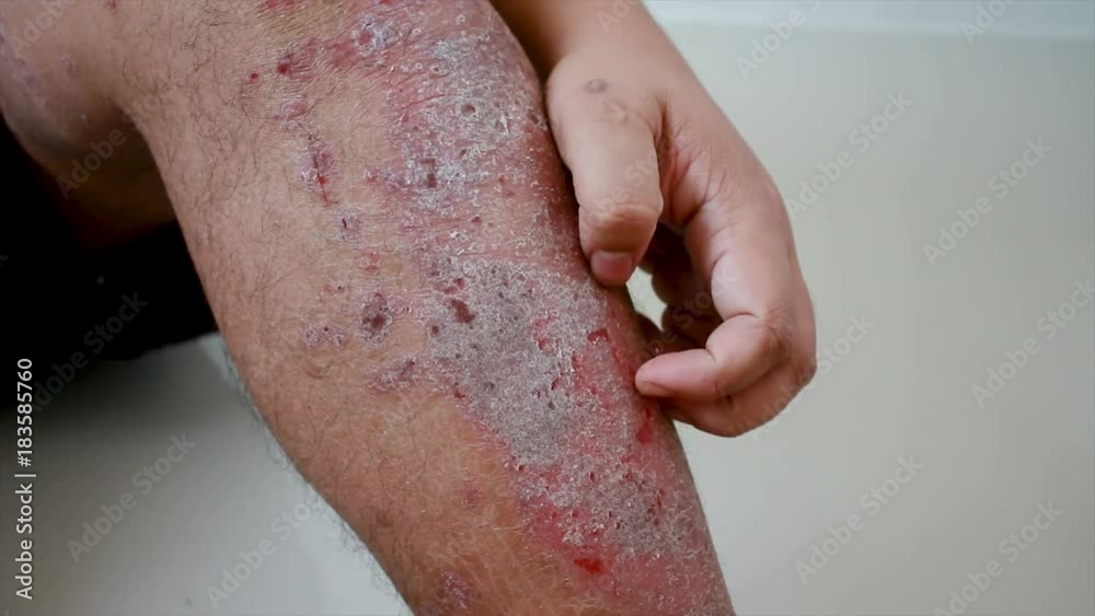 4K Close up shot hands of man scratching skin rash Dermatitis psoriasis ...