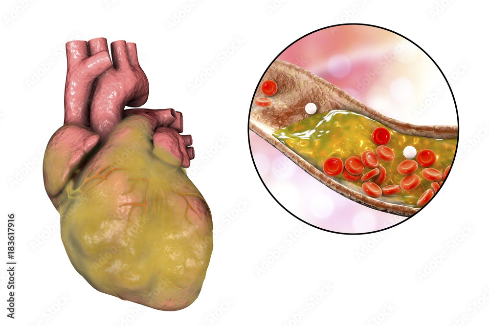 Obese heart and closeup view of coronary artery with cholesterol plaque ...