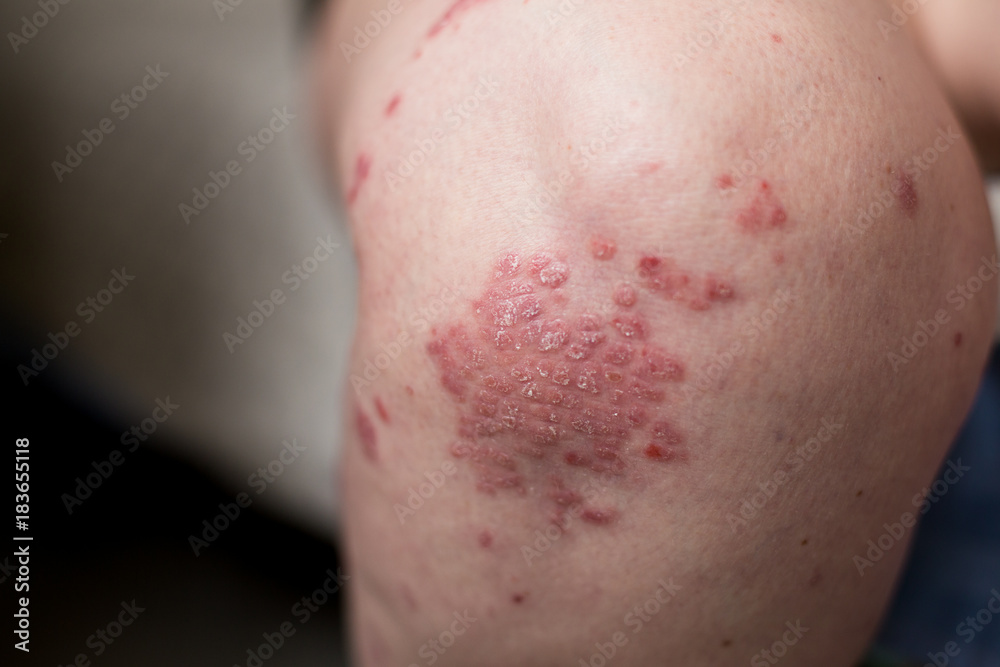 One Caucasian woman with psoriasis, eczema, atopic dermatitis on the ...