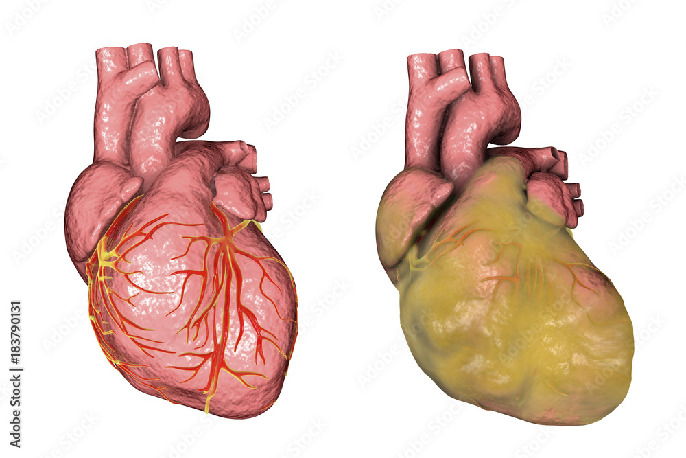 Healthy and obese heart with left ventricular hypertrophy isolated on ...